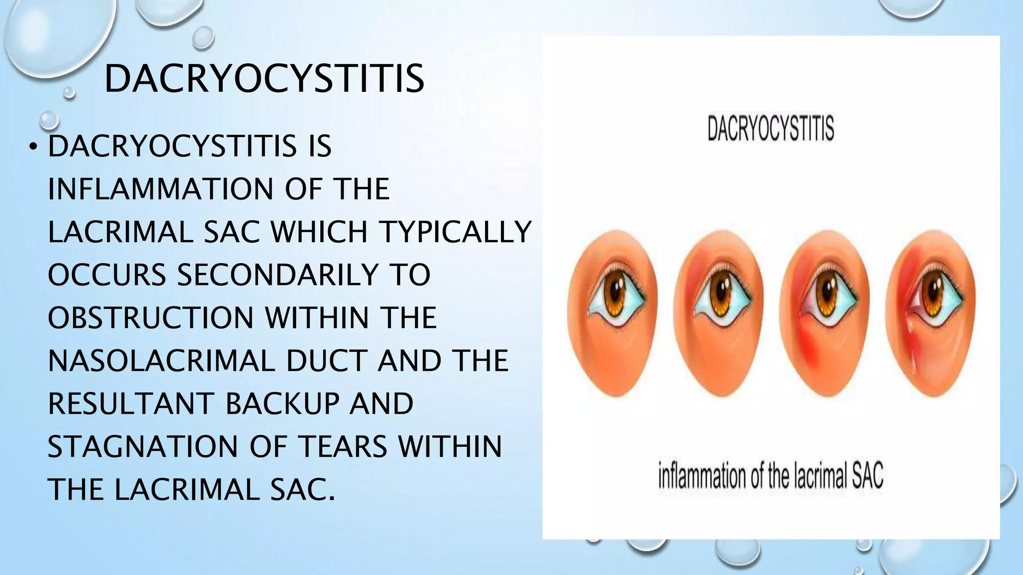 Opthalmology- inflammatory diseases of Eye.pptx