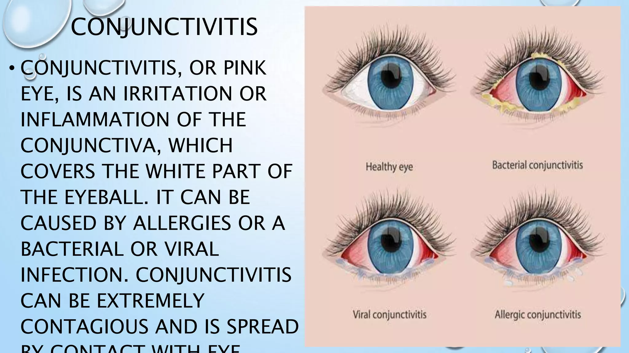 Opthalmology- inflammatory diseases of Eye.pptx
