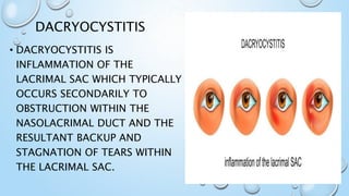 Opthalmology- inflammatory diseases of Eye.pptx