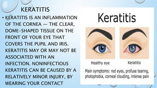 Opthalmology- inflammatory diseases of Eye.pptx