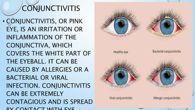 Opthalmology- inflammatory diseases of Eye.pptx | Eye and Vision ...