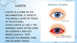 Opthalmology- inflammatory diseases of Eye.pptx