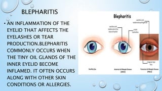 Opthalmology- inflammatory diseases of Eye.pptx