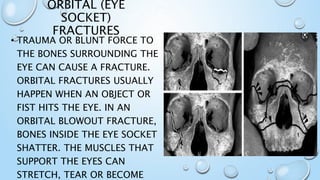 opthalmology - Injuries of organ of vision, eye..pptx