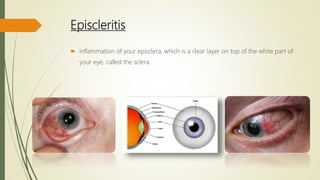 Opthalmology, the red eyes & more on the red eyes | PPT