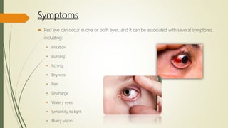 Opthalmology, the red eyes & more on the red eyes | PPT