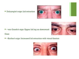 THYROID EYE DISEASE | PPT