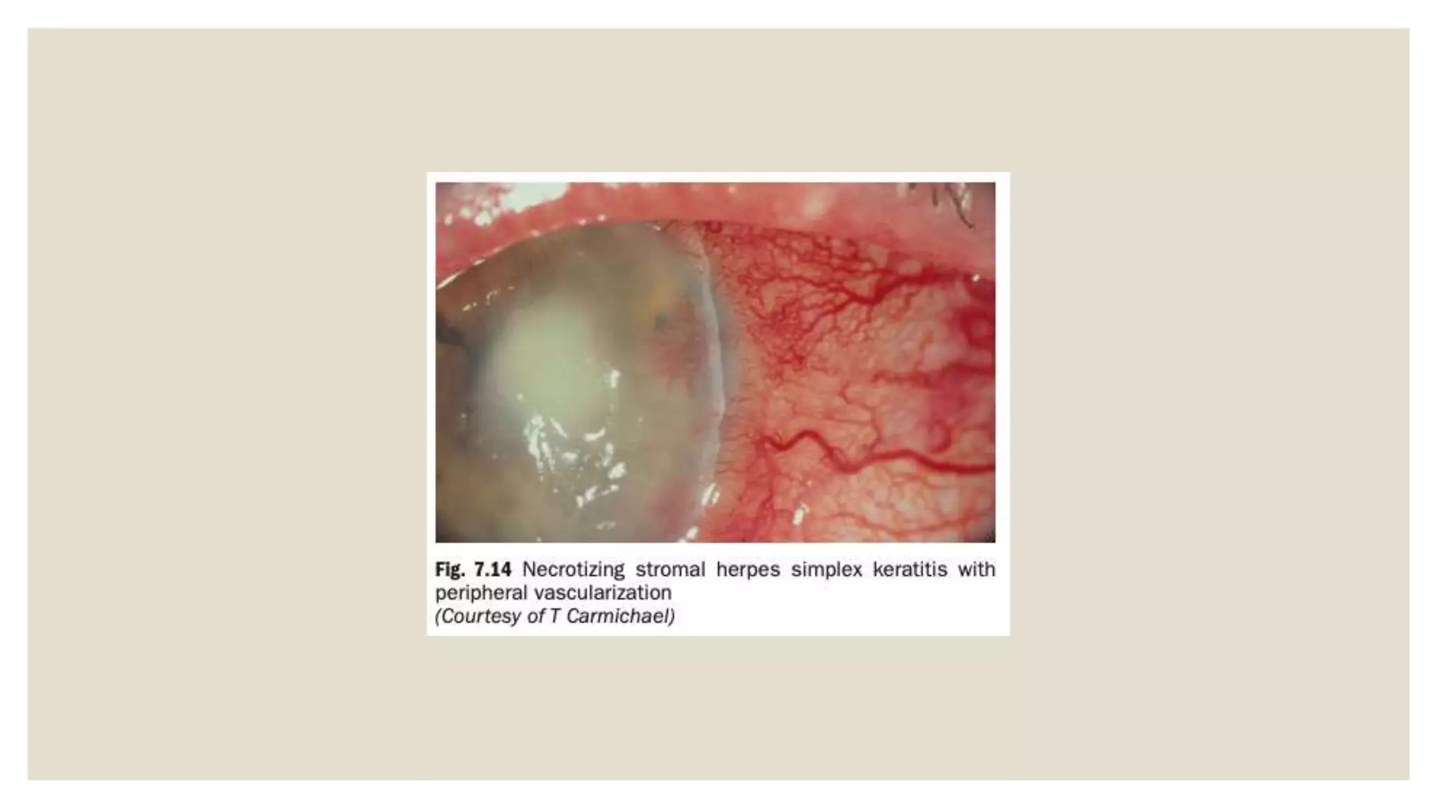 herpes simplex keratitis.pptx | Skin and Dermatology | Diseases and ...