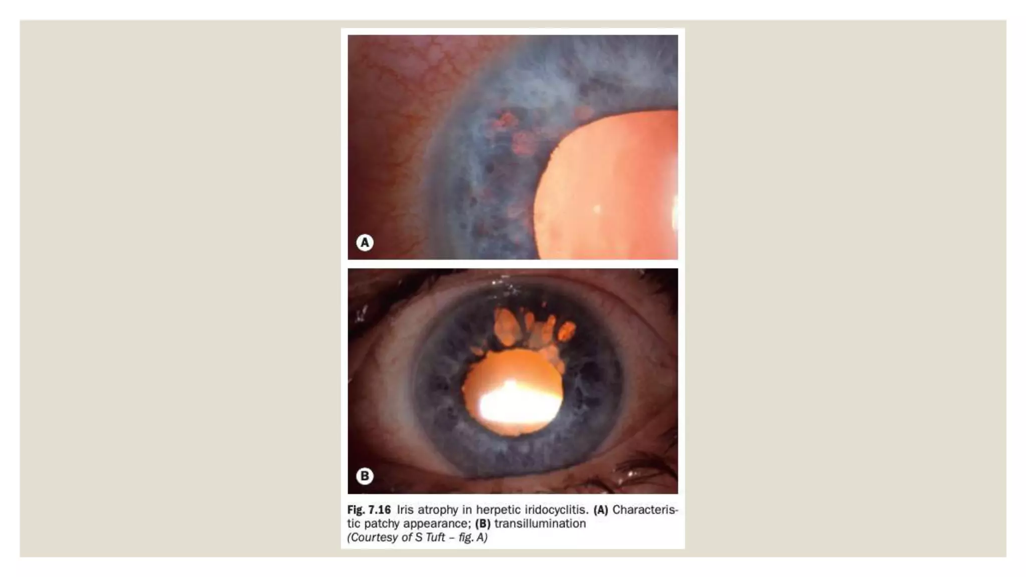 herpes simplex keratitis.pptx