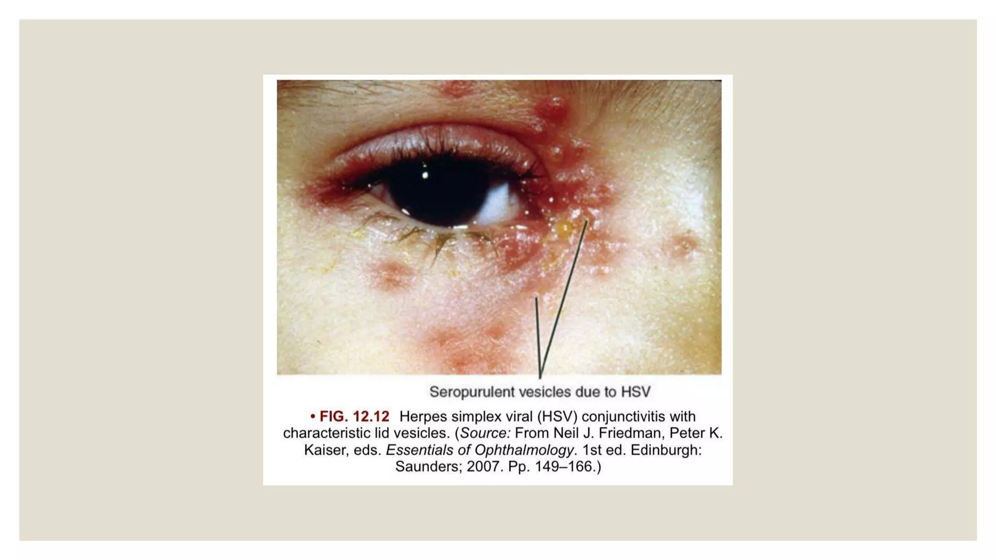 herpes simplex keratitis.pptx | Skin and Dermatology | Diseases and ...