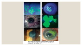 herpes simplex keratitis.pptx | Skin and Dermatology | Diseases and ...