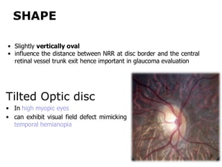 Optic Disc Evaluation in glaucoma and its applied | PDF