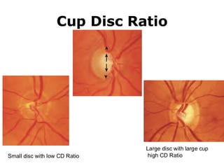 Optic Disc Evaluation in glaucoma and its applied | PDF