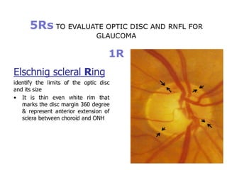 Optic Disc Evaluation in glaucoma and its applied | PDF