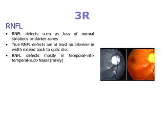 Optic Disc Evaluation in glaucoma and its applied | PDF