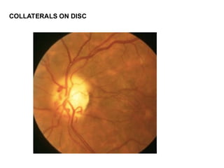 Optic Disc Evaluation in glaucoma and its applied | PDF