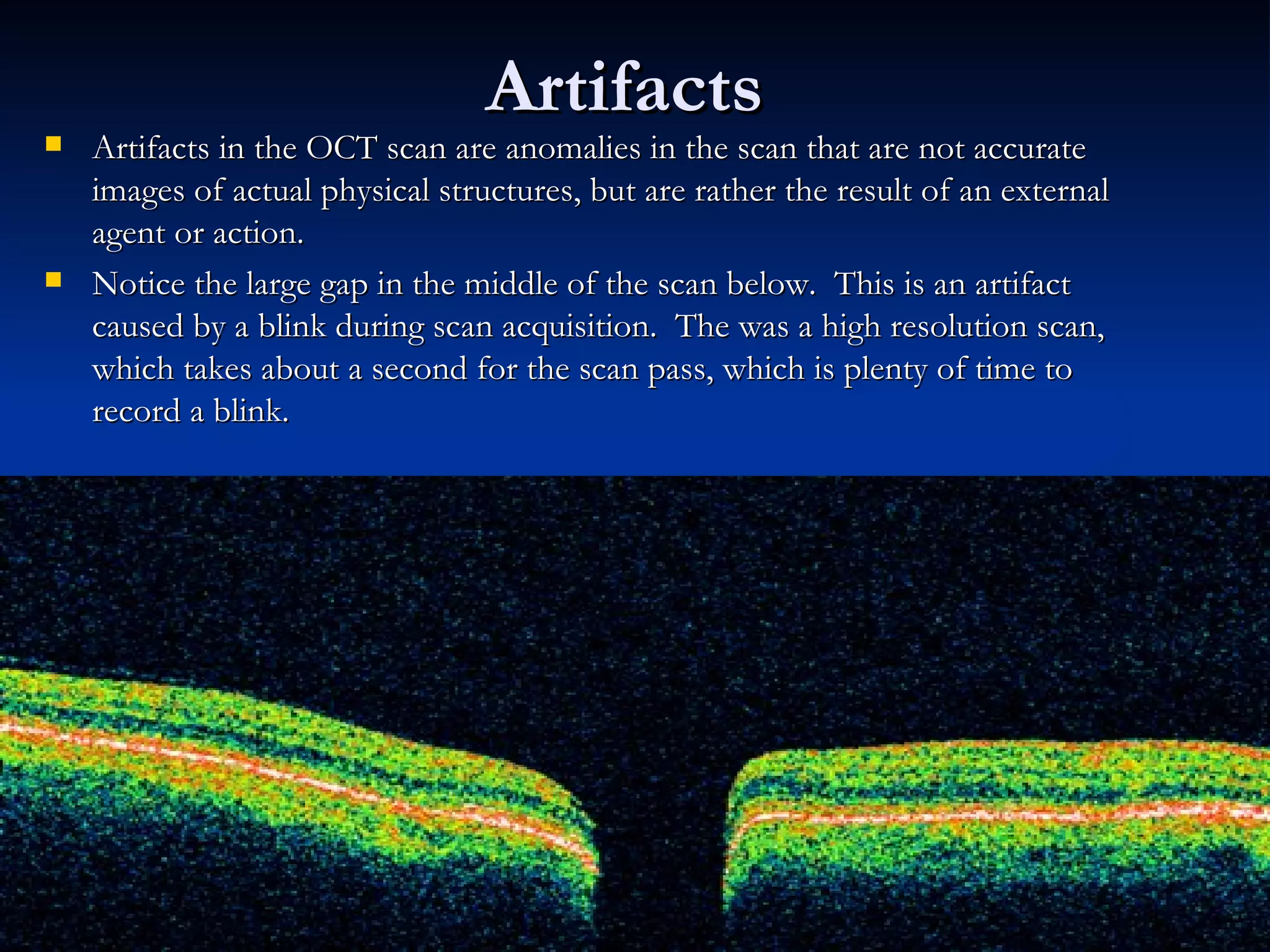 Optical Coherence Tomography - principle and uses in ophthalmology | PPT