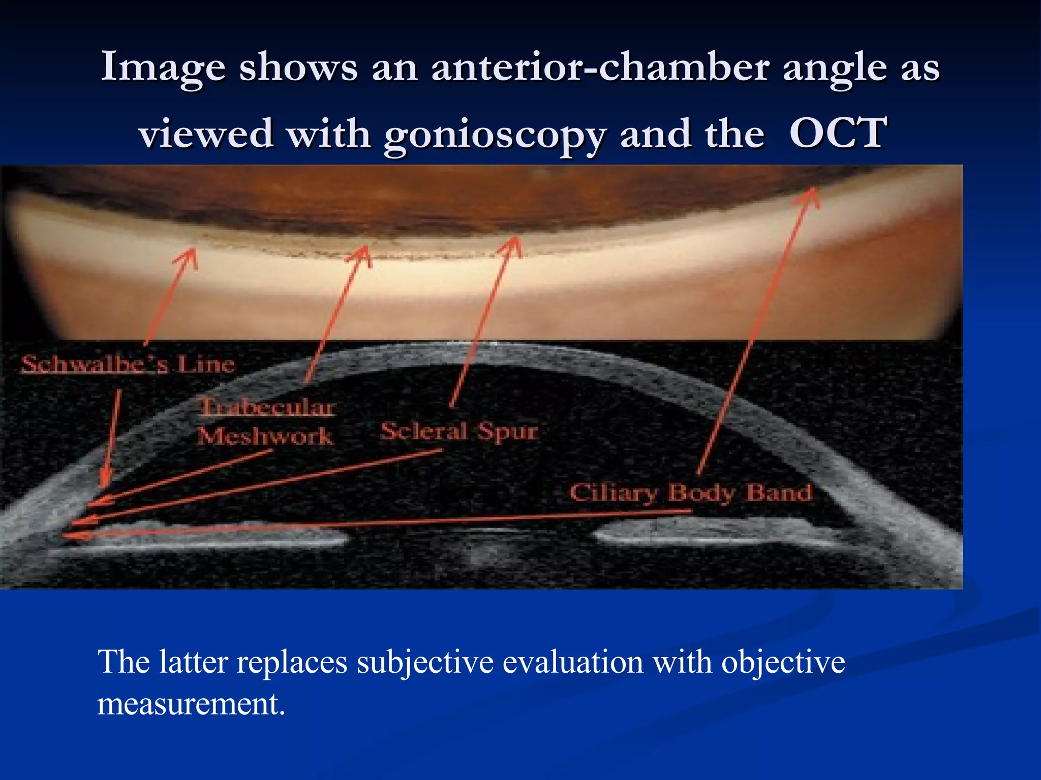 Optical Coherence Tomography - principle and uses in ophthalmology | PPT