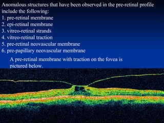 Optical Coherence Tomography - principle and uses in ophthalmology | PPT