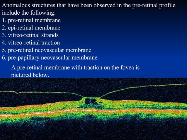 Optical Coherence Tomography - principle and uses in ophthalmology | PPT