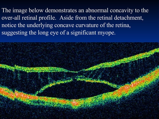 Optical Coherence Tomography - principle and uses in ophthalmology | PPT