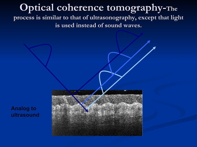 Optical Coherence Tomography - principle and uses in ophthalmology | PPT
