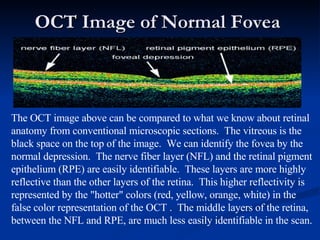 Optical Coherence Tomography - principle and uses in ophthalmology | PPT