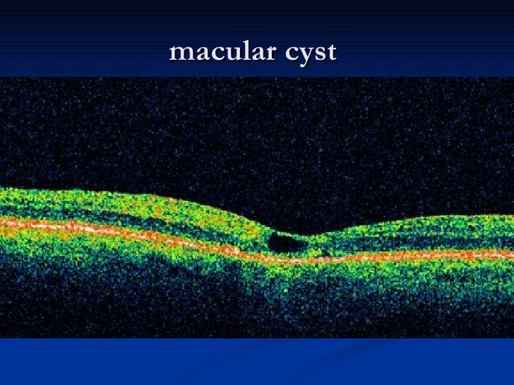 Optical Coherence Tomography - principle and uses in ophthalmology