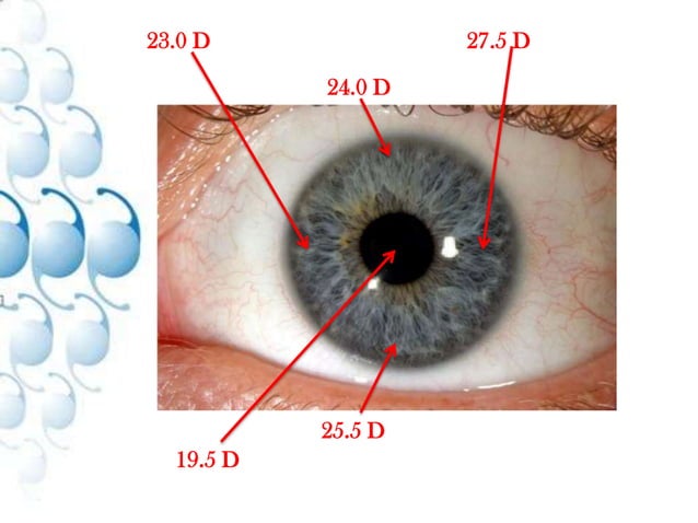 Optical Biometry Measurements For Future Iol’S | PPTX | Eye and Vision ...