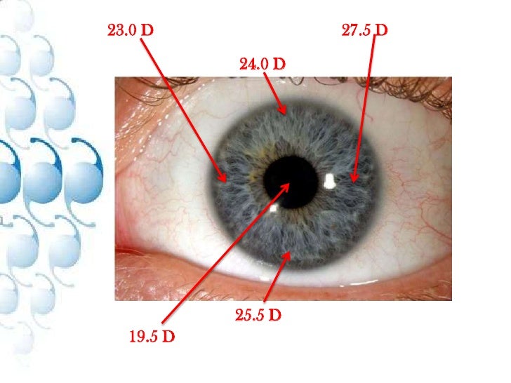 Optical Biometry Measurements For Future Iol’S