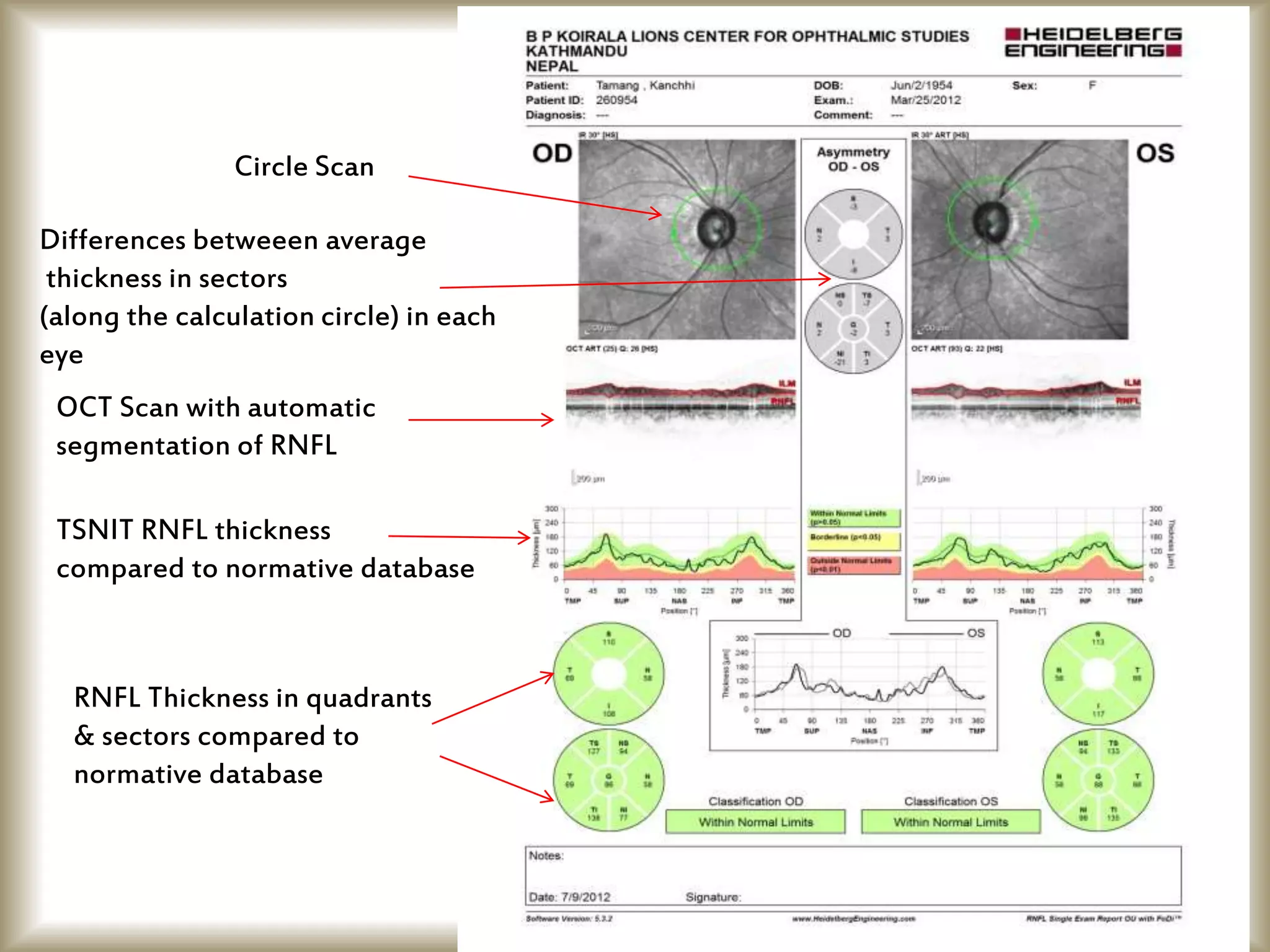 Optical Coherence Tomography | PPTX