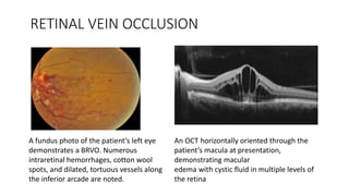 Optical coherence tomography)(OCT) | PPTX