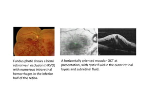 Optical coherence tomography)(OCT) | PPTX