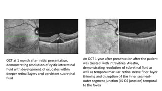 Optical coherence tomography)(OCT) | PPTX
