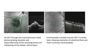 Optical coherence tomography)(OCT) | PPTX
