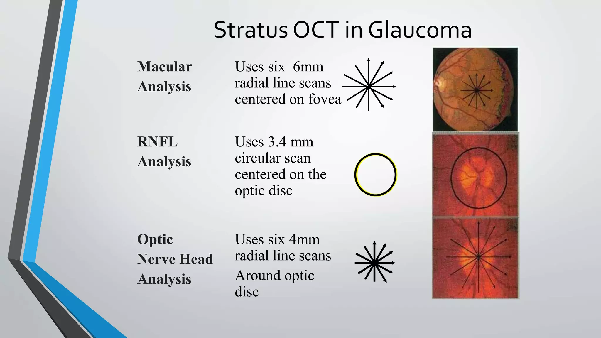 Optical coherence tomography in glaucoma - Dr Shylesh Dabke | PPTX