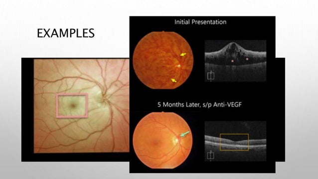 OPTICAL COHERENCE TOMOGRAPHY Study.pptx