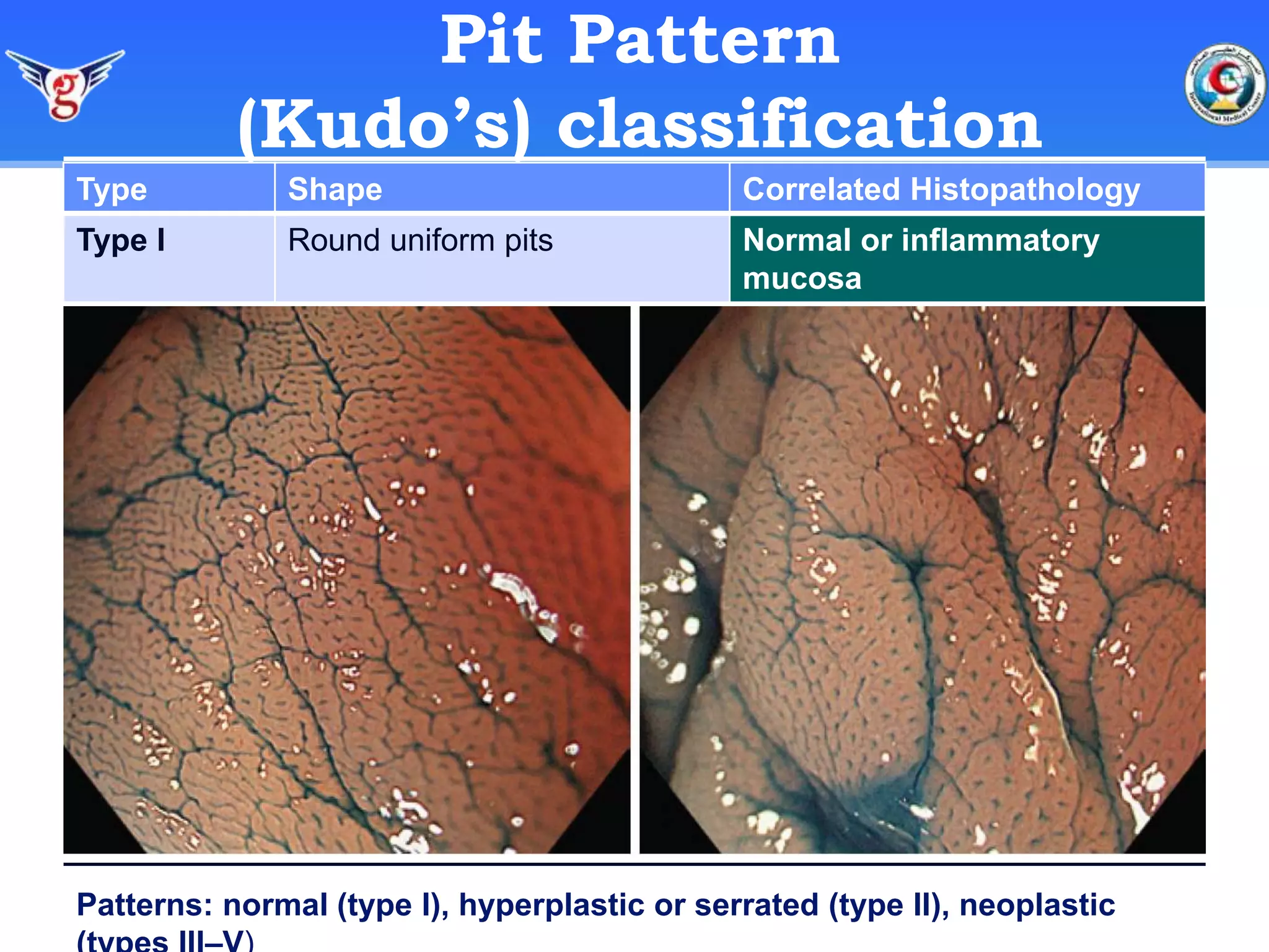 Optical diagnosis of colorectal neoplasia. GastroMilitary 2021. https ...
