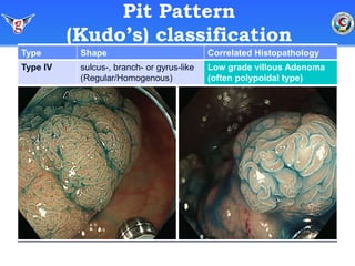 Optical diagnosis of colorectal neoplasia. GastroMilitary 2021. https ...
