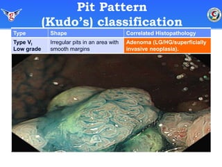 Optical diagnosis of colorectal neoplasia. GastroMilitary 2021. https ...