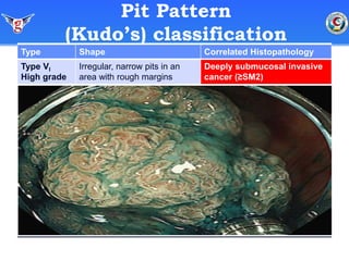 Optical diagnosis of colorectal neoplasia. GastroMilitary 2021. https ...