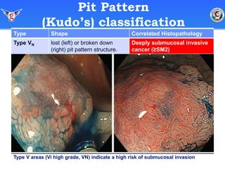 Optical diagnosis of colorectal neoplasia. GastroMilitary 2021. https ...