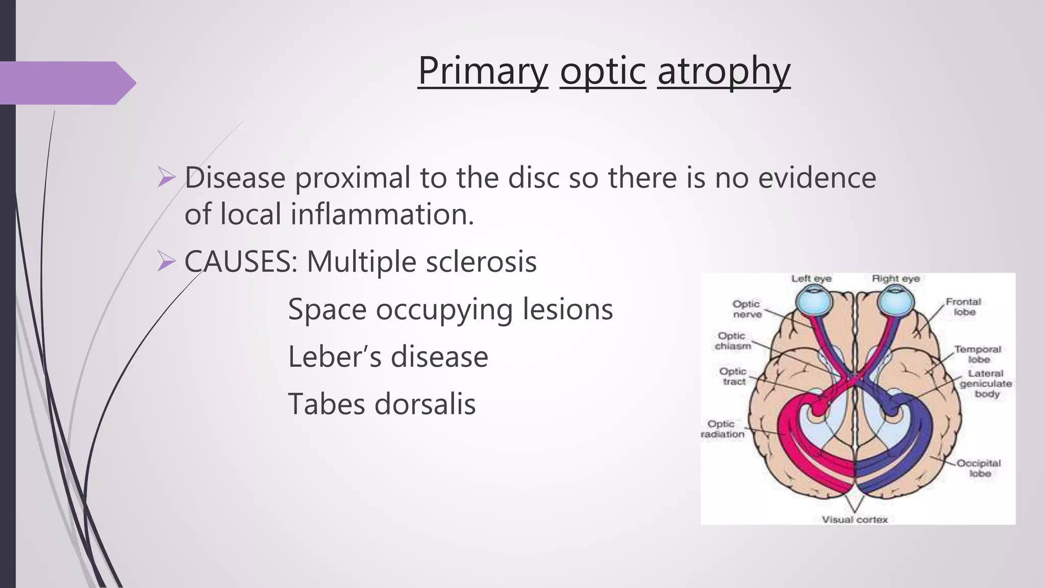 Optic atrophy | PPTX
