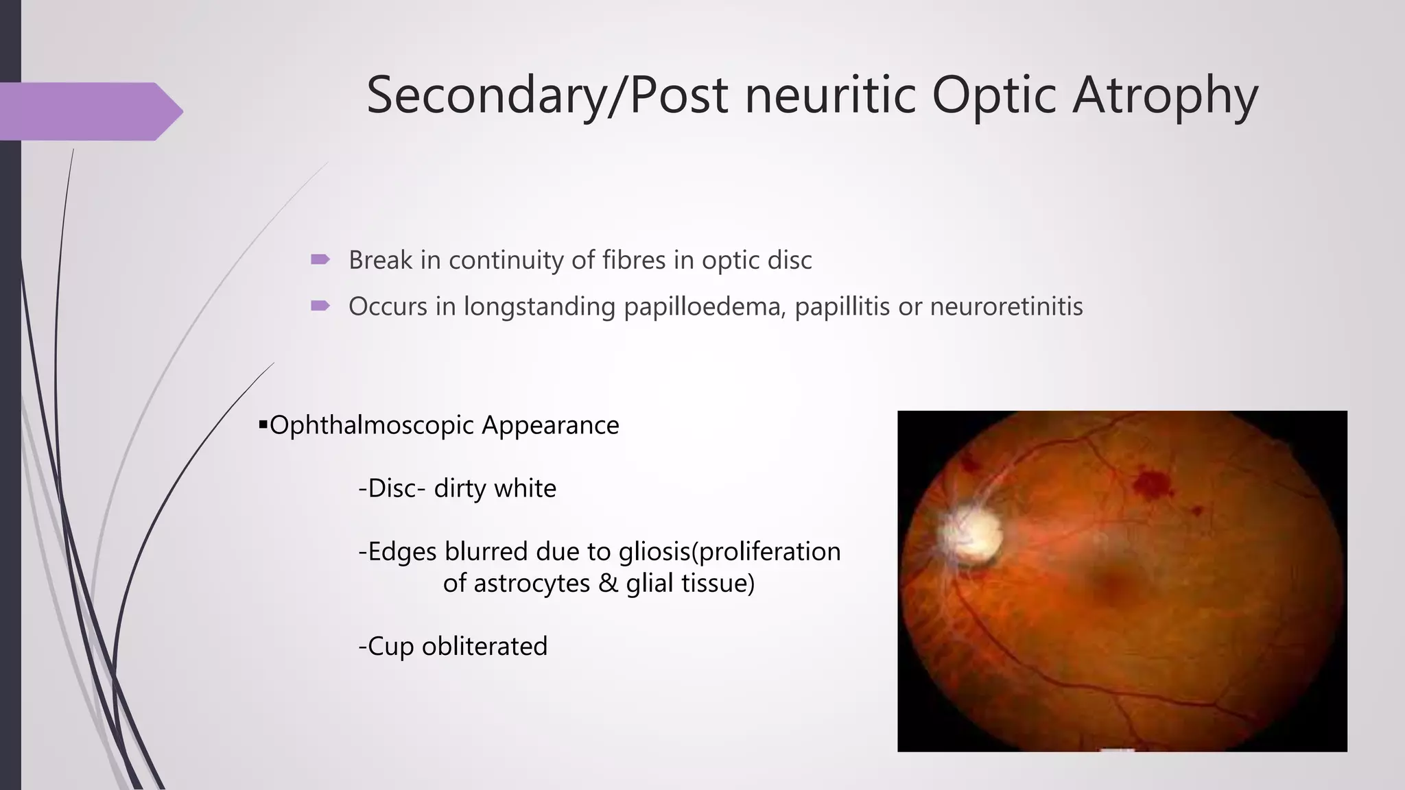 Optic atrophy | PPTX