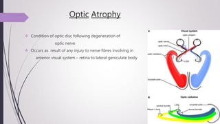 Optic atrophy | PPTX