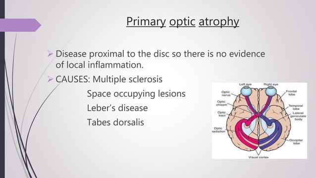 Optic atrophy | PPT