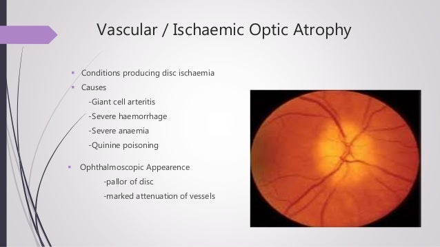 Optic atrophy