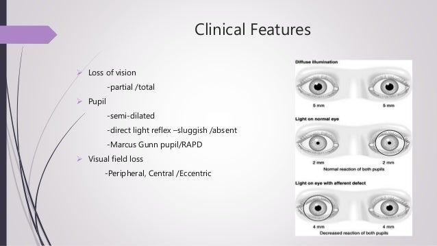 Optic atrophy