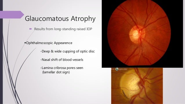 Optic atrophy