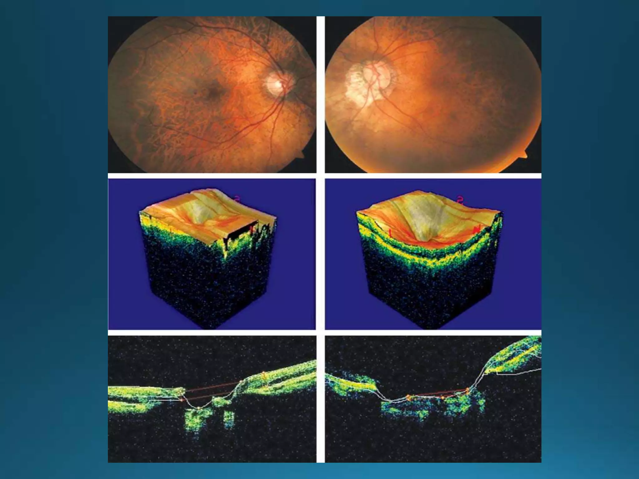 Optic atrophy | PPTX